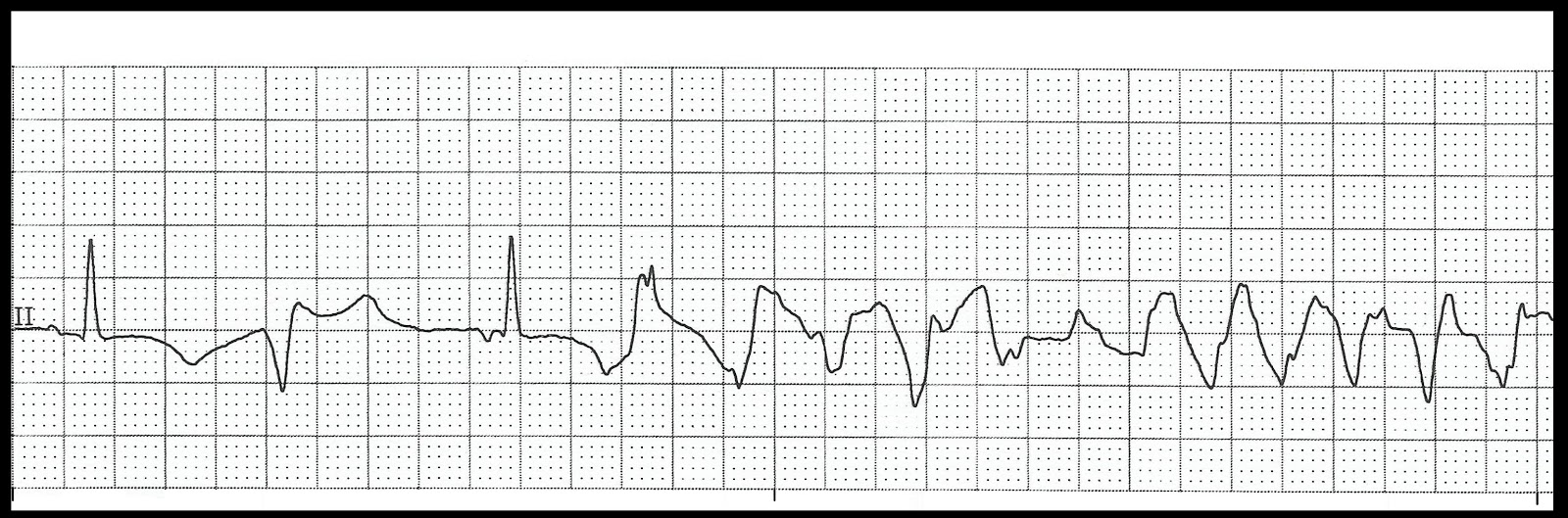 EKG Rhythm Strip Quiz 117