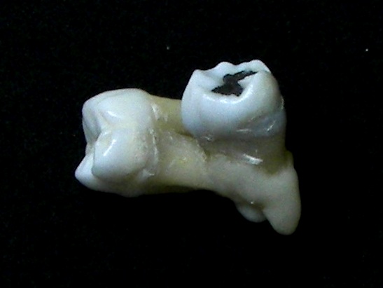 Deformutilation: Concrescence - Tooth Fusion