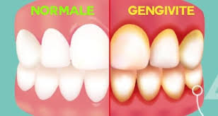 Rimedi Naturali Vita Sana: Infiammazione alle gengive: cause e rimedi ...