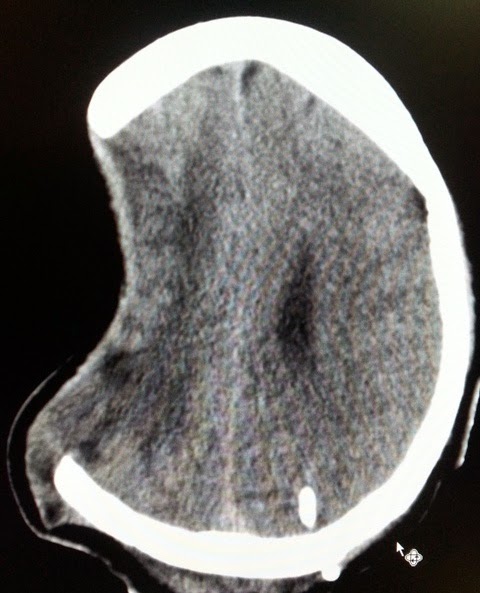 TREPHINE SYNDROME WITH PARADOXICAL HERNIATION | The Third Eye ...