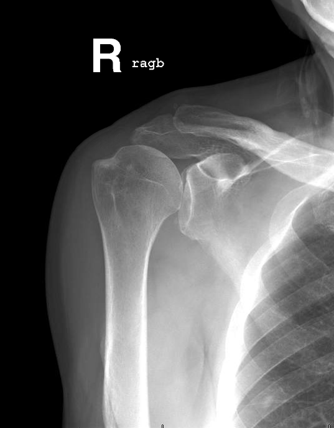 Shoulder and Elbow Surgery: The ideal position of the glenosphere in ...