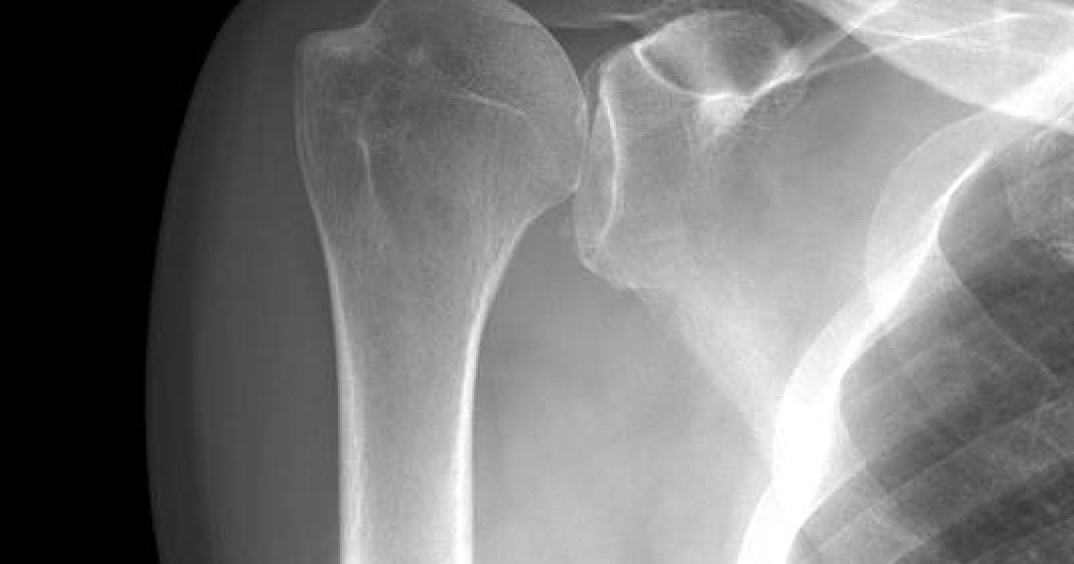 Shoulder and Elbow Surgery: The ideal position of the glenosphere in ...