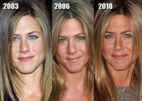 Qualitytime: Celebs Who Have Used Botox