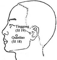 Acupuncture: SI - 19 (SMALL INTESTINE - 19)