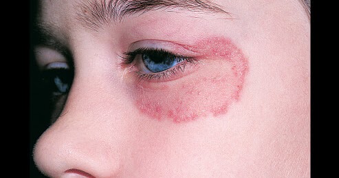 TINEA (JAMUR) ~ Healthy it Easy