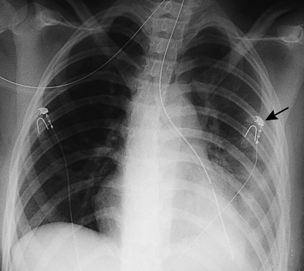 Case of the Day: Coffee Grounds