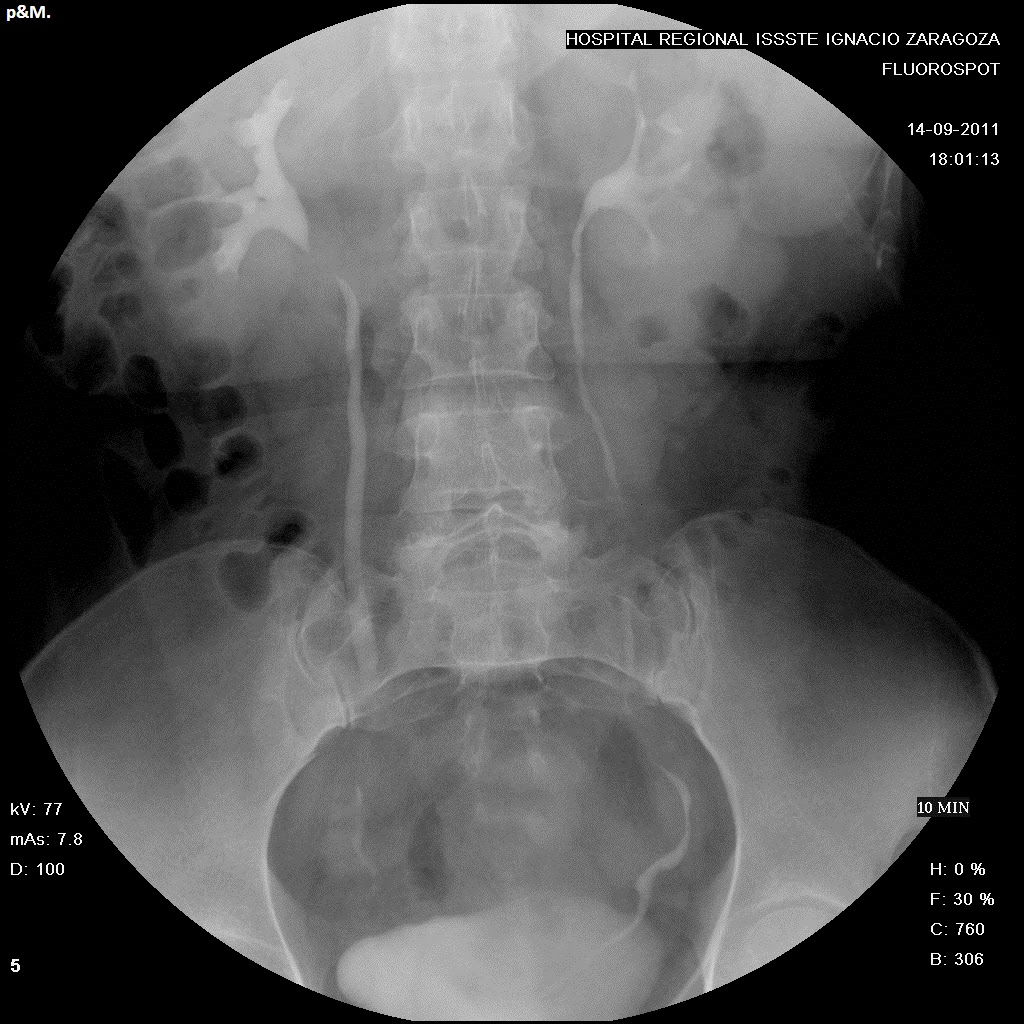 RADIOLOGIA e IMAGEN CETIS 76: UROGRAFIA EXCRETORA