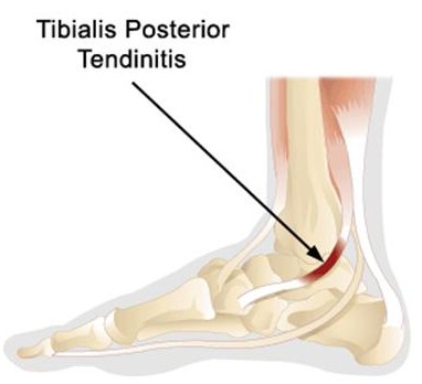 27/05/11 Estat de la tendinitis del tibial posterior dret