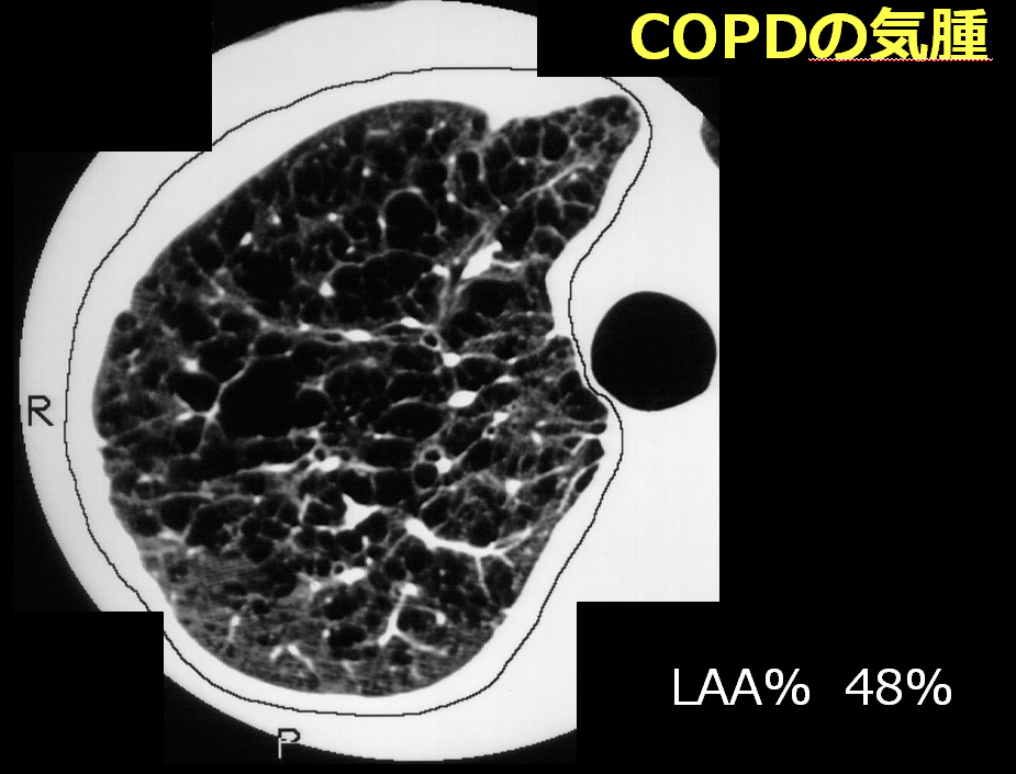 Pulmonalist: 喘息とCOPDの鑑別 #4 胸部CT