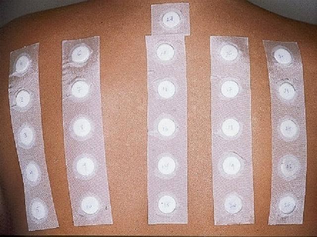 Un parche es capaz de identificar ciertas alergias