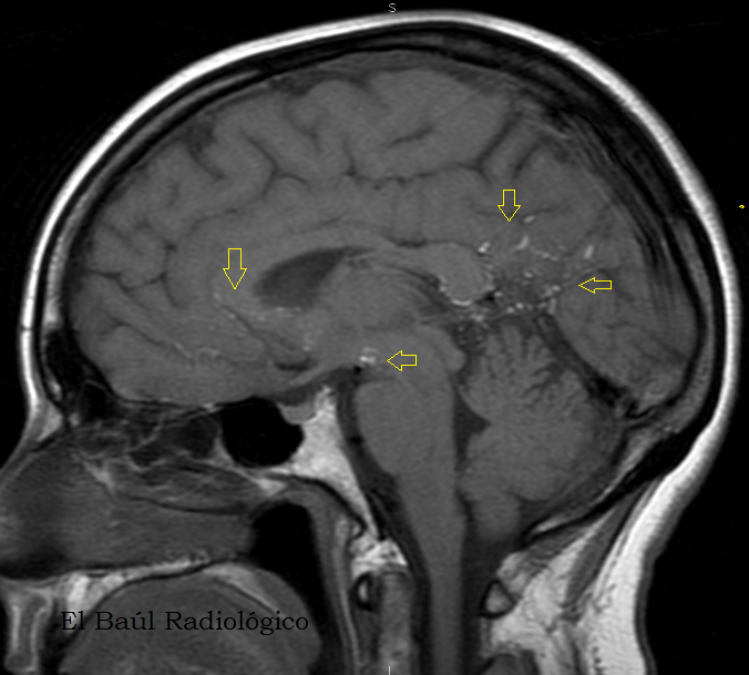 El Baúl Radiológico: 2) QUISTE DERMOIDE INTRACRANEAL (Intracranial ...