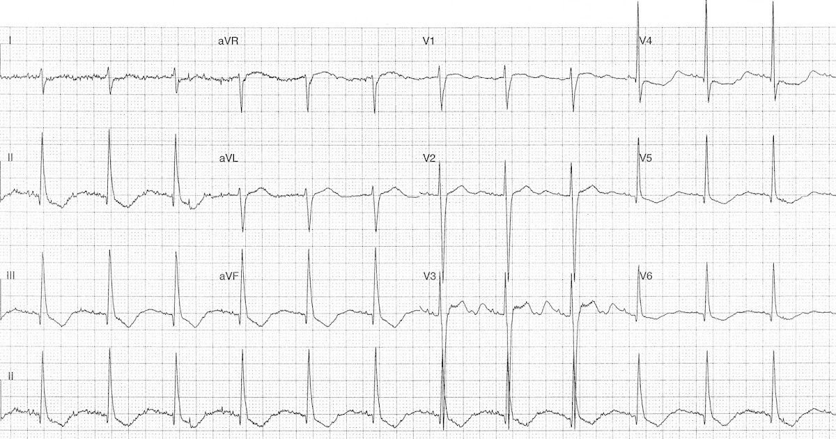 ECG of the Week: ECG of the Week - 27th June 2016 - Interpretation