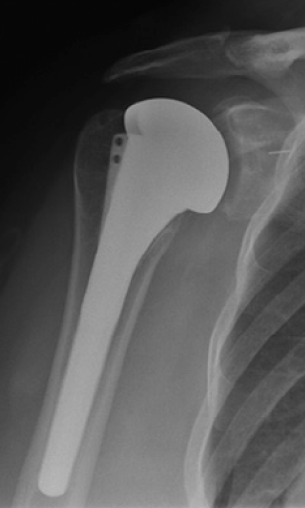 Shoulder Arthritis / Rotator Cuff Tears / Shoulder Pain : Shoulder ...