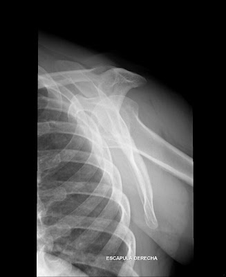 Posiciones Radiográficas de STIM: Rx Escápula (Perfil)