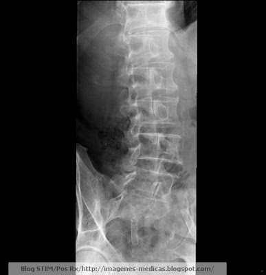 Posiciones Radiográficas de STIM: Rx Columna Lumbar (Oblícua)