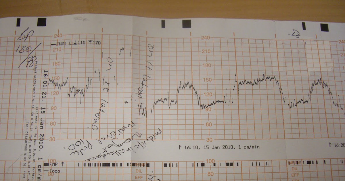 Infomidwife: CTG - Case study what would you do?