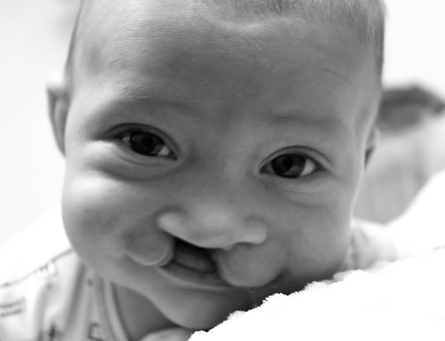 Step by Step Cleft: Taping and Ear tubes