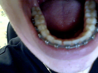 Orthodontie + rétrognathie mandibulaire: 11 mois