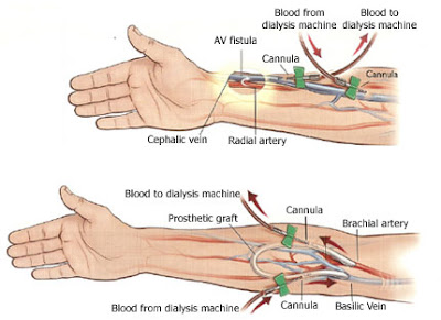 Vascular Access: Makes Chronic Dialysis Possible