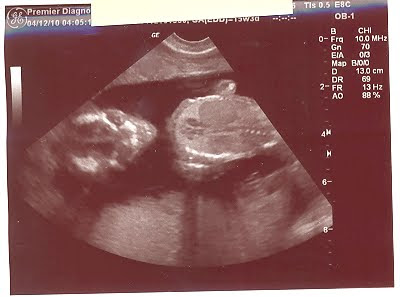 The Perfect Match: 12 week and 14 week ultrasound pictures.