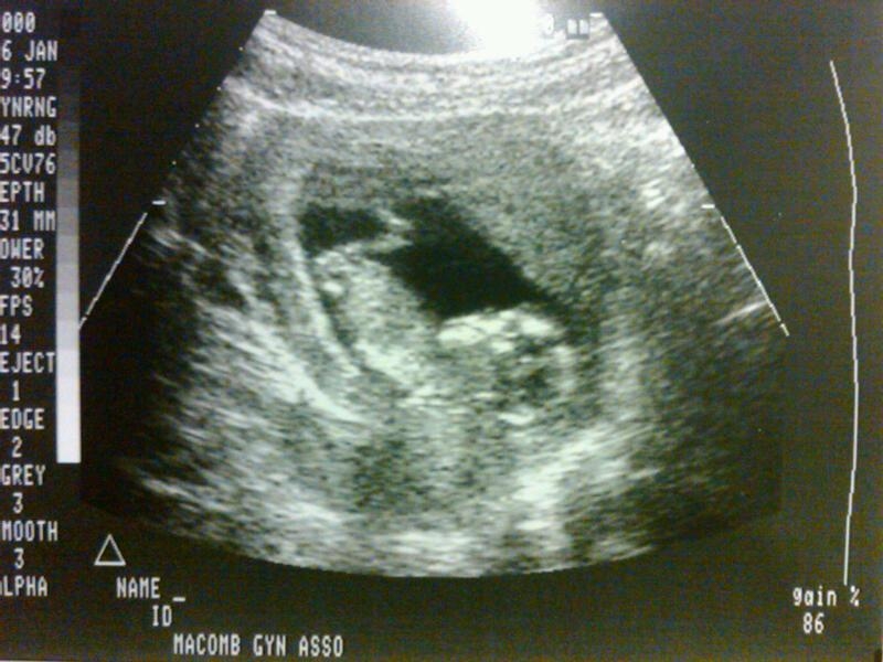 mraux: 12 5 week ultrasound