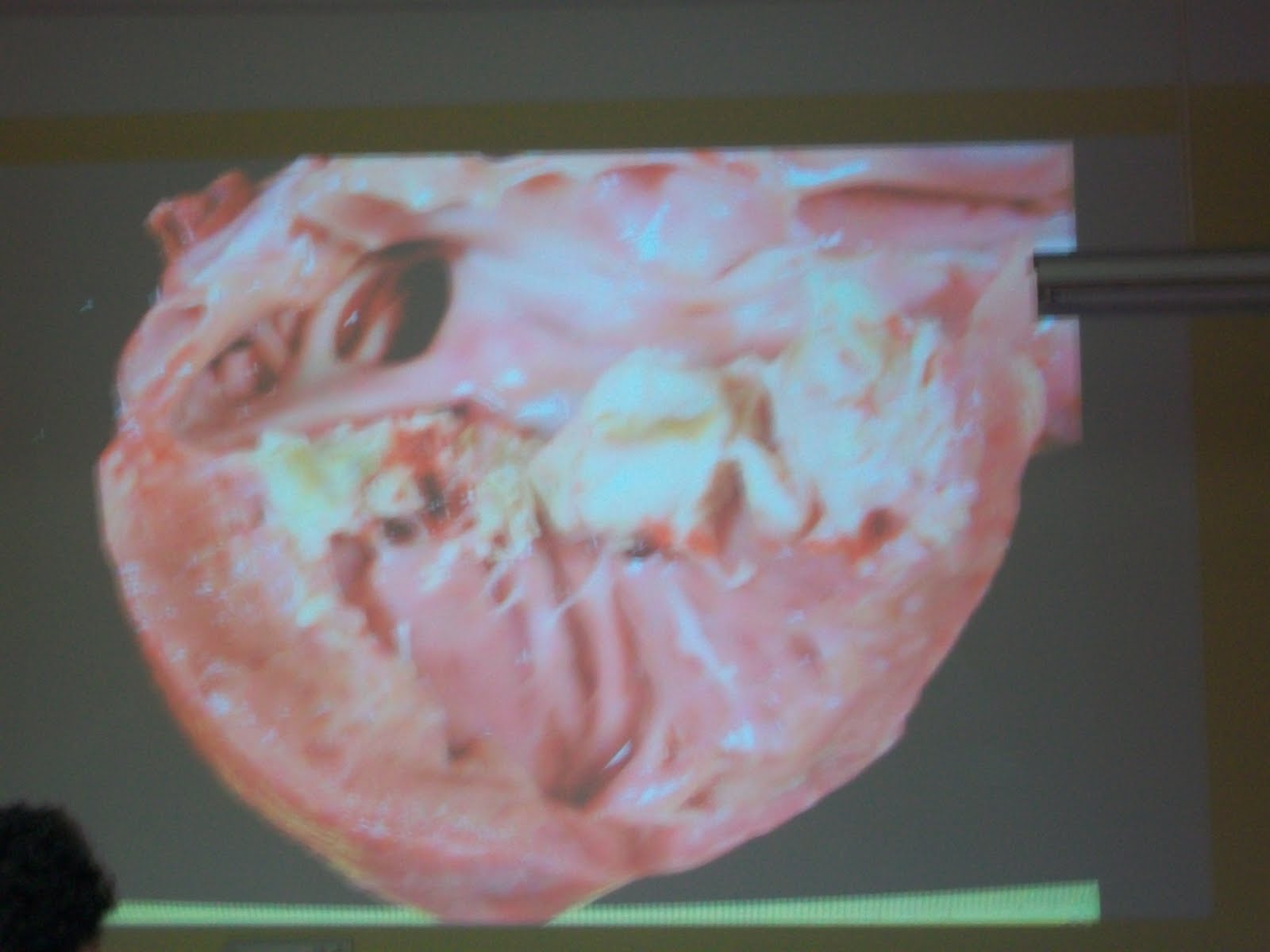 ignafvet: Patologia Sistema Cardiovascular (Endocardio)