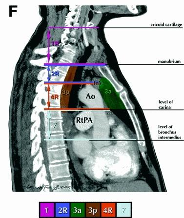 My Hodgkin's Journey: 23rd - Abnormal soft tissue