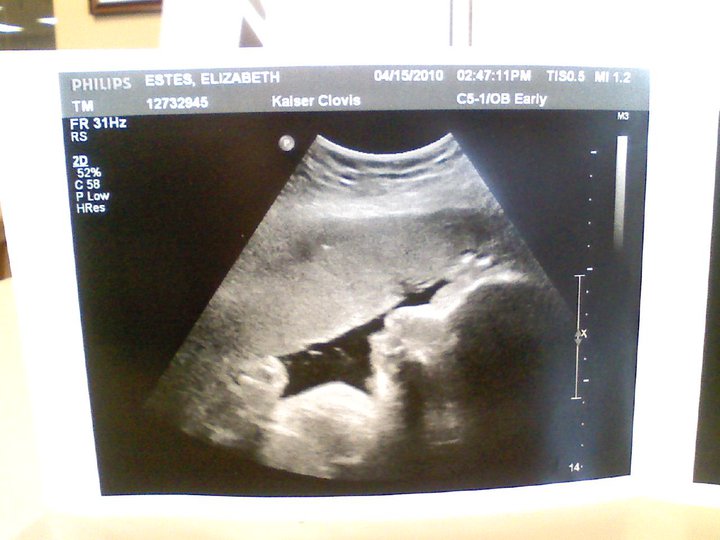 The Best of Estes: 34 Week Ultrasound