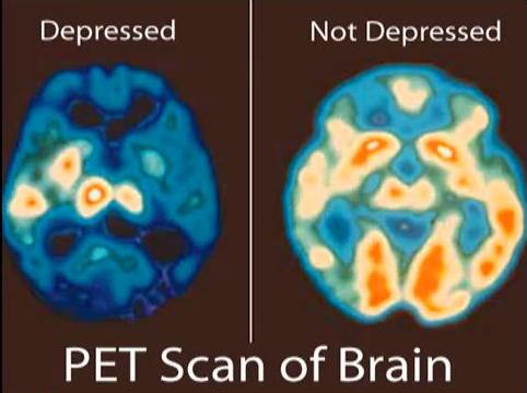 Biochemistry in Medical Conditions: Depressing Anti-Depressants