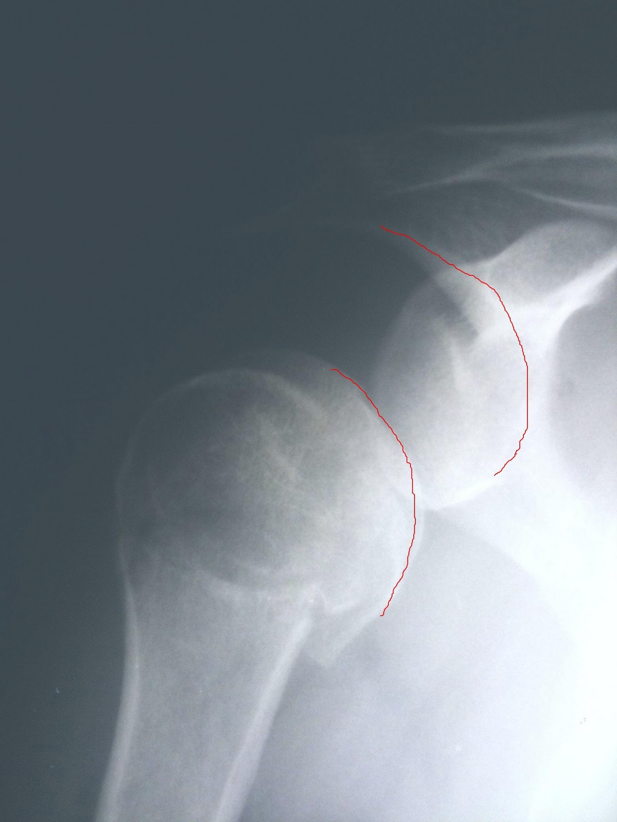 Joe's Humerus Fracture
