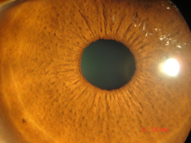 how to take care of your eyes: NORMAL IRIS TEXTURE