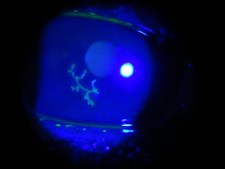 how to take care of your eyes: Herpetic Dendritic Ulcer