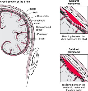 PG Medic: Subdural/Extradural Hematoma