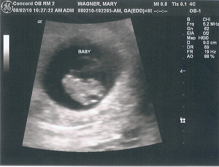 ultrasounds at 8 weeks