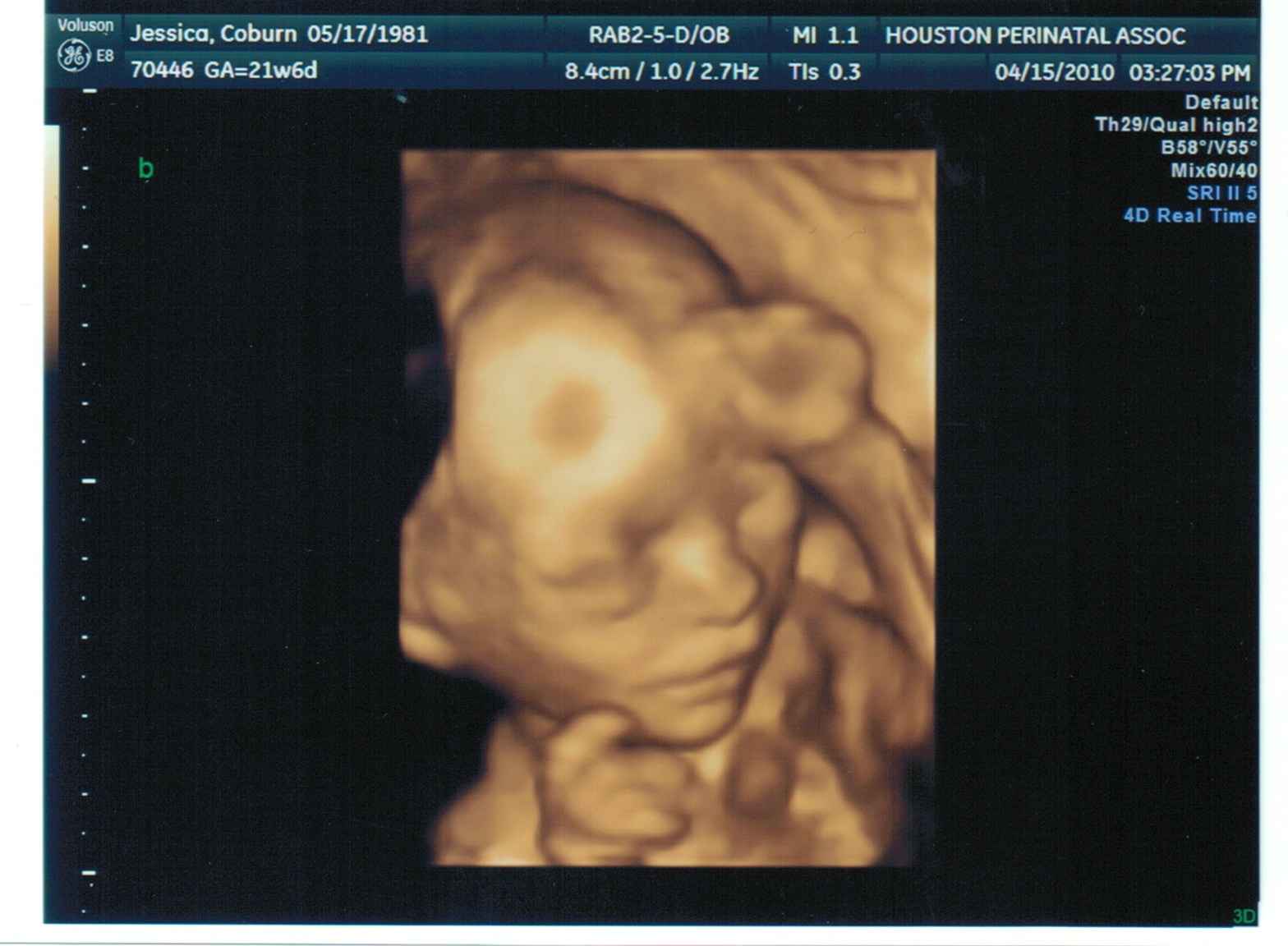 TheTwins: New 4D Ultrasound