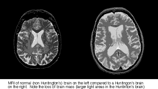 Huntington's Disease-HD: How is HD inherited...?