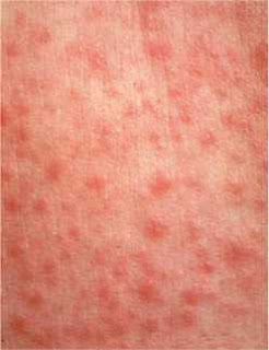 Shopping Galore: Measles (Tigdas) Symptoms