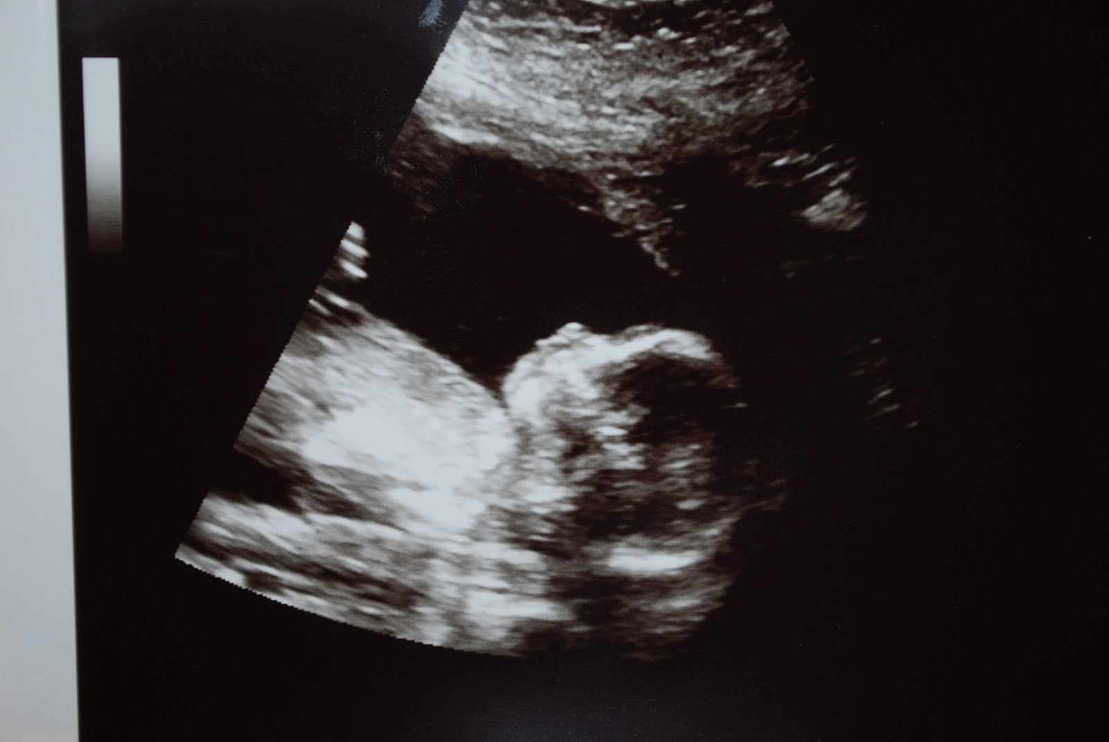 Following The Kies Family: 19 week Ultrasound...........