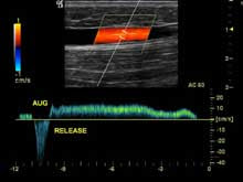 Adventures in Varicose Vein Ultrasound: What to expect during your ...
