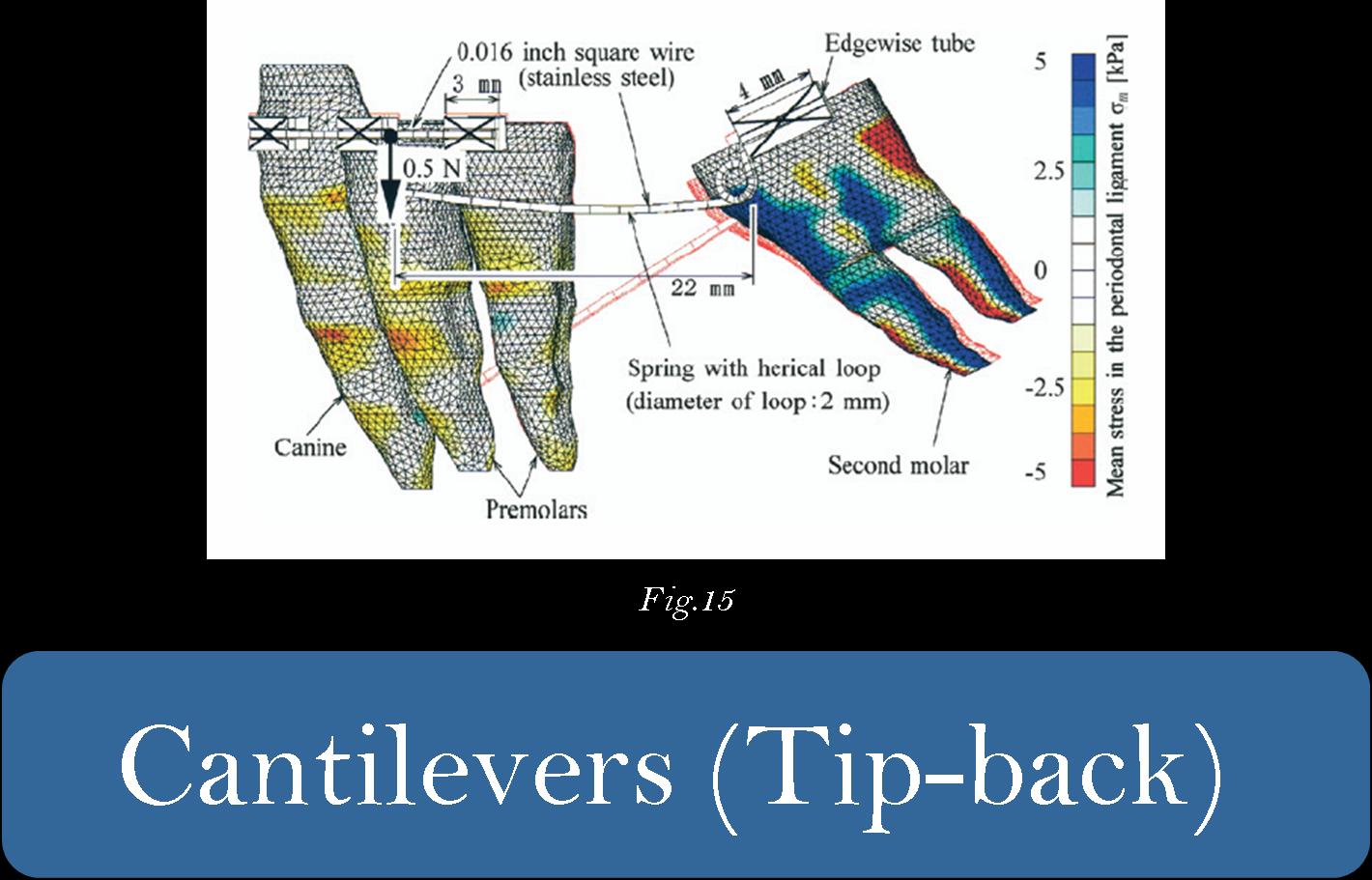 Mosquera_BM_MT: VERTICALIZACIÓN DE MOLARES-Cantiliver TIP-BACK