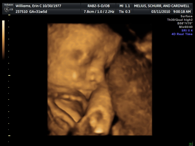 Williams' Pregnancy: ULTRASOUND WEEK 32
