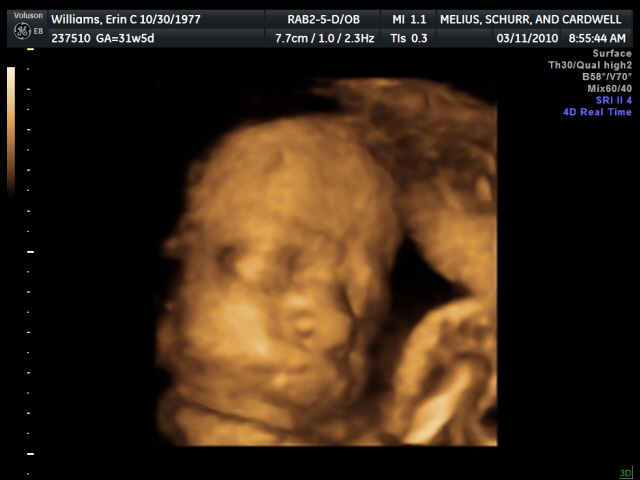 Williams' Pregnancy: ULTRASOUND WEEK 32