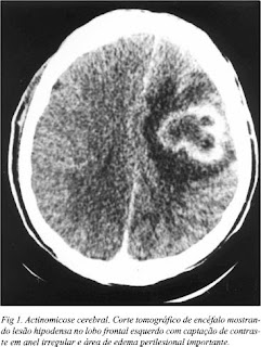fisioterapia: • ABCESSO CEREBRAL