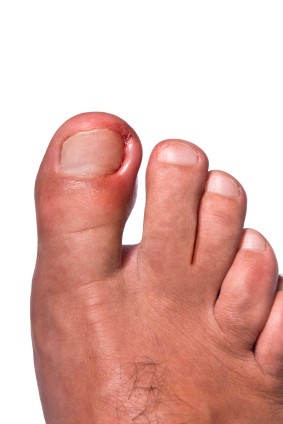 Inflamed Ingrown Toenail ~ Ingrown Toenail