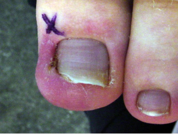 Ingrown Toenail Infection Pictures ~ Ingrown Toenail