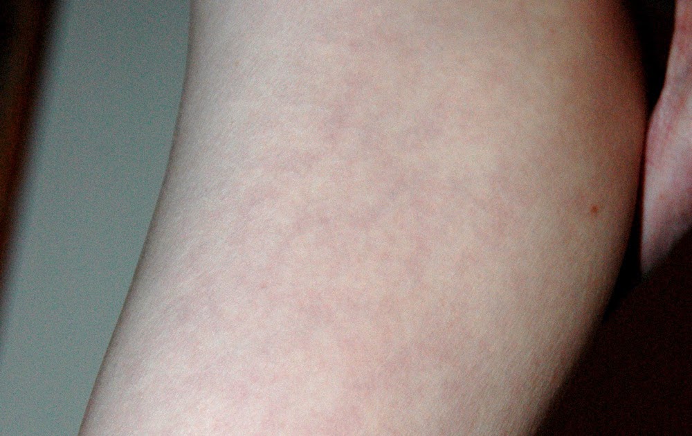 Lyme is real: Beware of Lyme and Fifth's Disease!