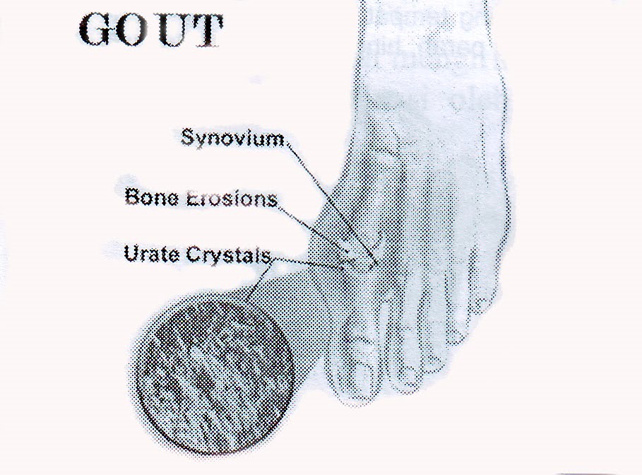 blog: Penyakit Gout atau Asam Urat
