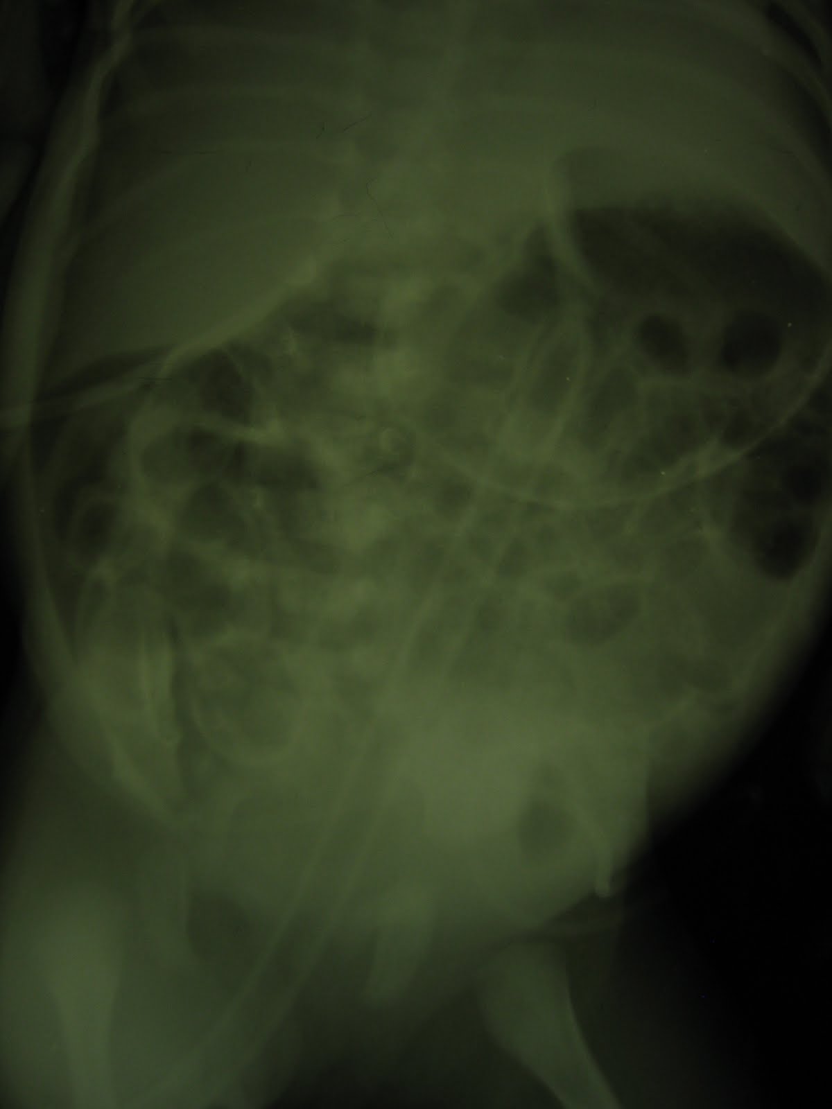 Bedah Anak-RSUD AWS: Komplikasi pemasangan pipa rektal untuk dekompresi ...