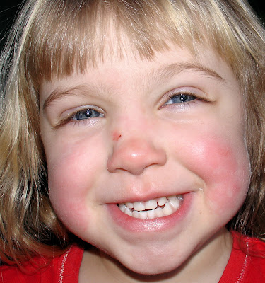 The Good Life: Fifth Disease (Slapped Cheek Syndrome)