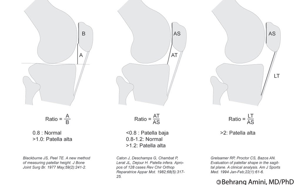 Roentgen Ray Reader: Patellar Height